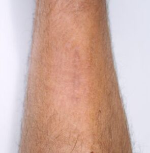 Scar Revision - Dermatology Center of Northern California