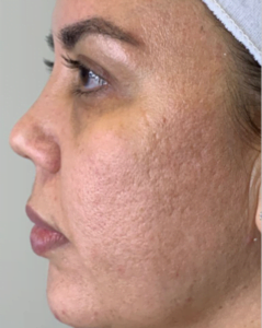 HALO® Laser Treatment - Dermatology Center of Northern California
