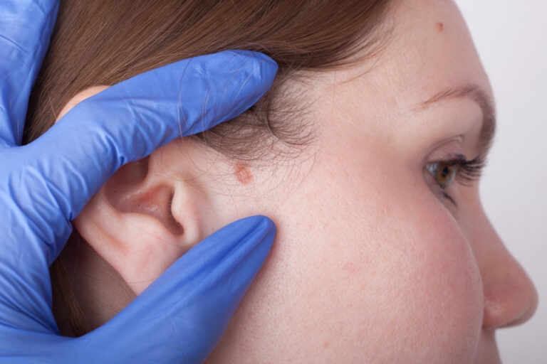 How Mohs Surgery Works to Effectively Treat Skin Cancer - Dermatology ...